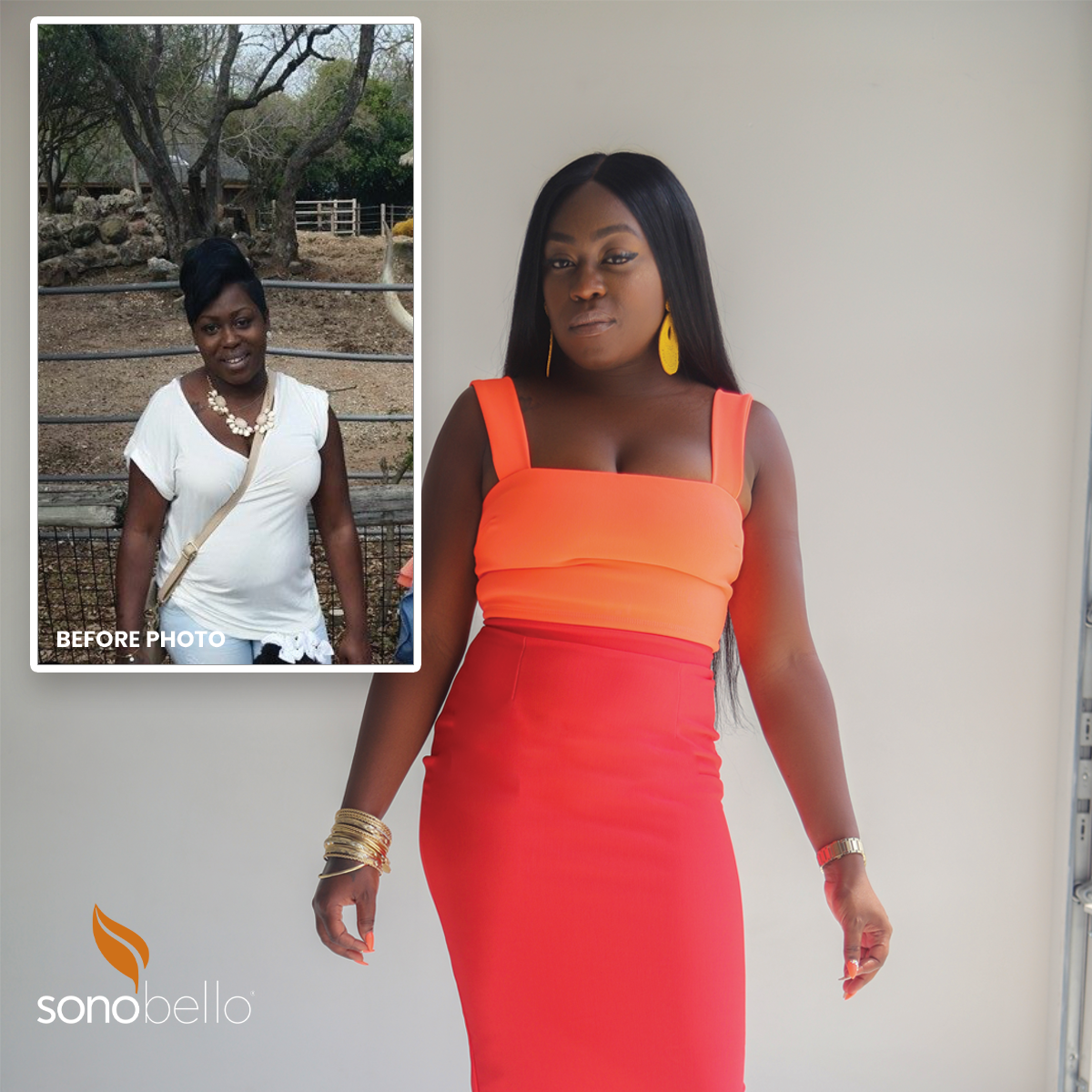 Stephanie Came Out of Her Shell After Her Liposuction - Sono Bello