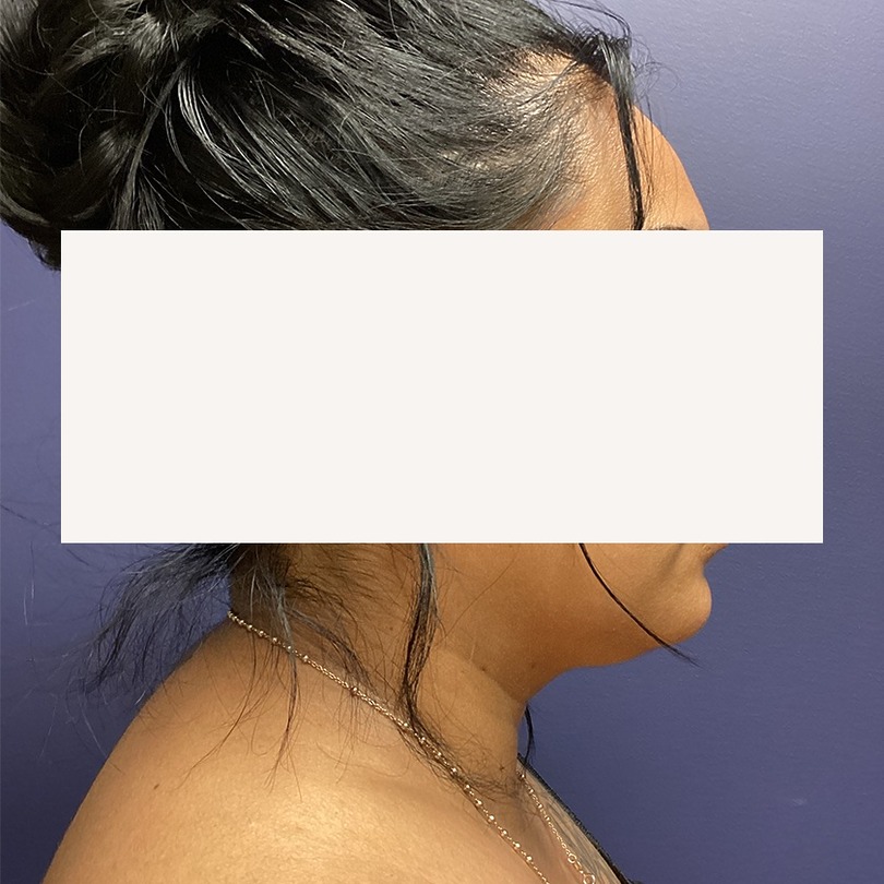 Chin Fat Removal | Sono Bello