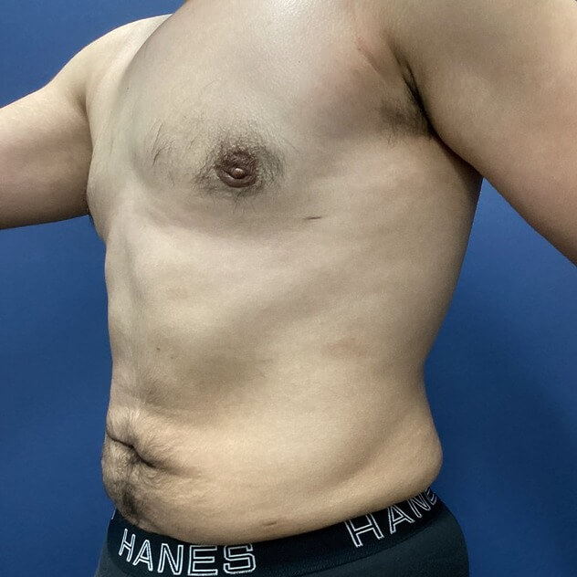 Gynecomastia Procedure for a More Masculine Chest | Sono Bello