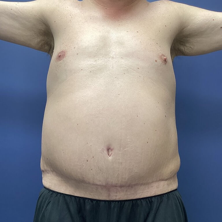 Male Excess Skin Removal | Sono Bello