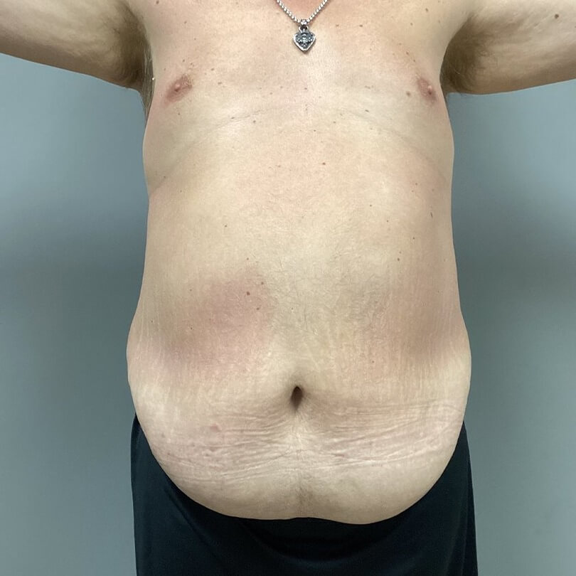 Male Excess Skin Removal | Sono Bello